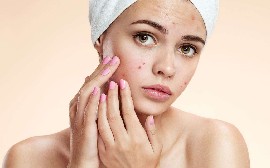 AcnÃ© de grossesse: pouvant Ãªtre traitÃ© de faÃ§on naturelle